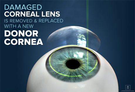 Corneal Surgery & Treatment | Northeast Ohio Eye Surgeons