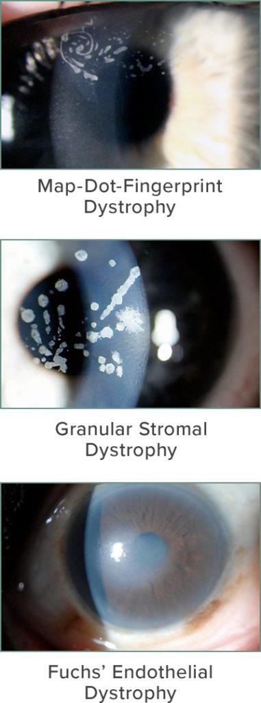 Corneal Dystrophies Treatment | Northeast Ohio Eye Surgeons