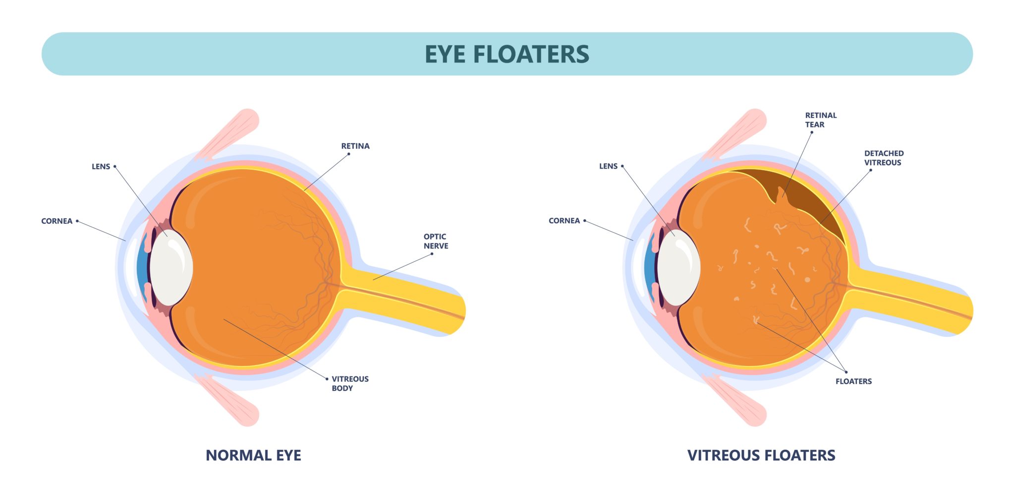 Retinal Tears & Holes Symptoms and Treatment